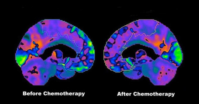 Chemo Brain Is Real. Here's What Researchers Are Saying...