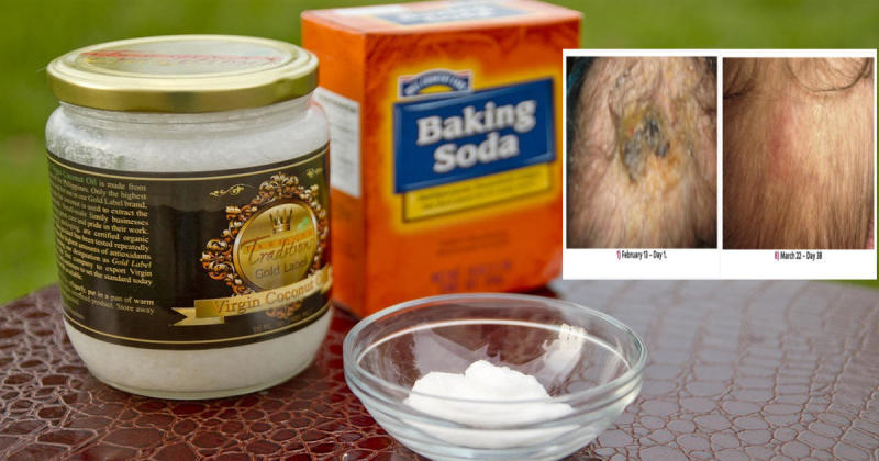 How One Woman Dealt With Her Skin Cancer At Home – Using Coconut Oil ...