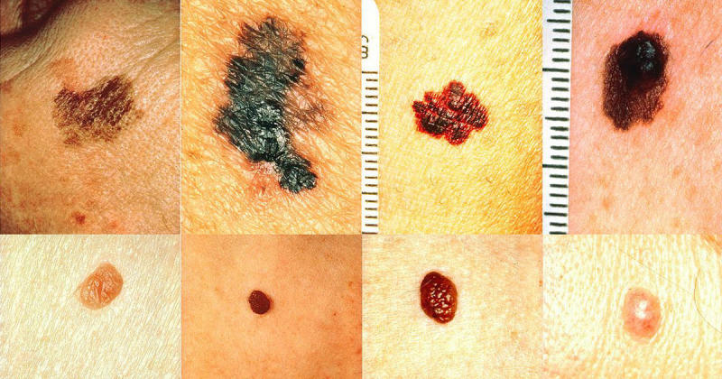 How To Recognize Skin Cancer – This Could Save Your Life