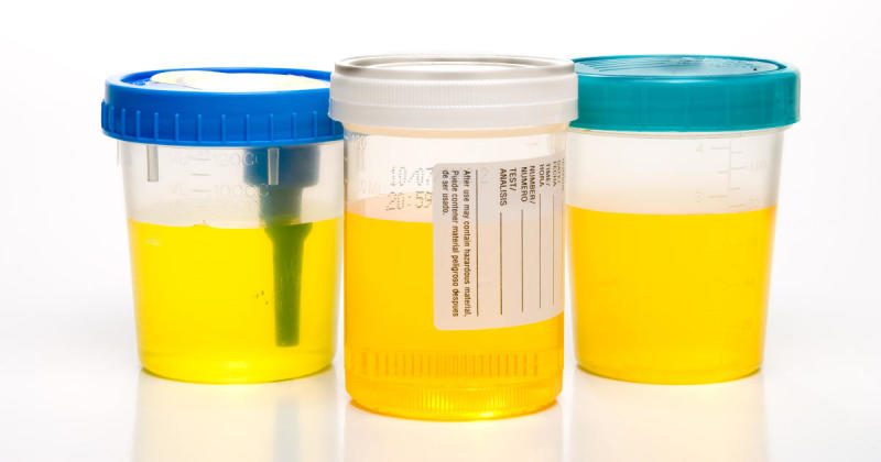 What Your Pee Color Says About Your Health And Hydration