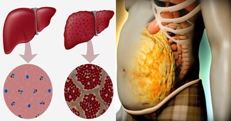 How To Detox Your Liver In Just 72 Hours (boost Metabolism)
