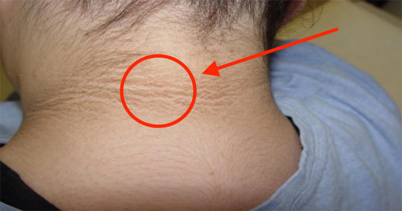 If You Notice A Dark Ring Around Your Neck, Go See Your Doctor ...