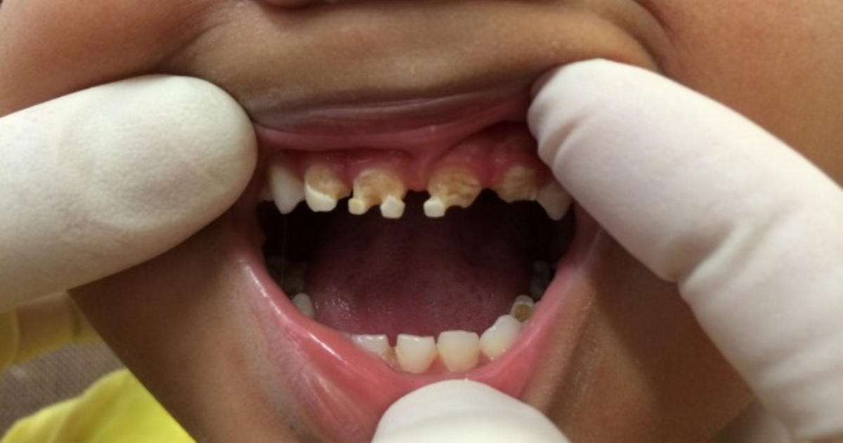 You Will Be Shocked By What Caused This Child s Massive Tooth Decay 