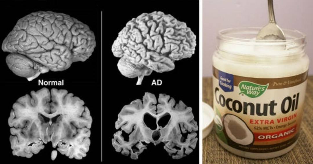 He Eats 2 Tbs Of Coconut Oil Twice A Day For 60 Days And This Happens ...