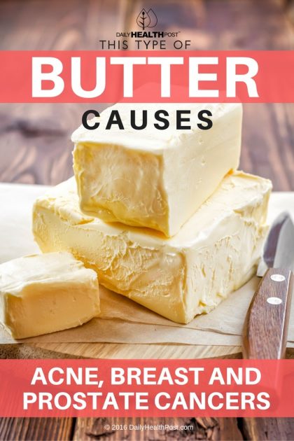 This Type Of Butter Causes Acne, Breast And Prostate Cancers