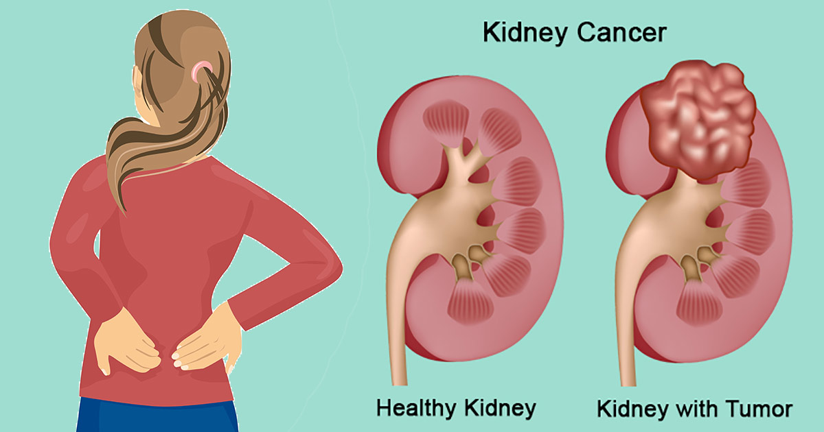 11 Kidney Cancer Symptoms (and How To Manage It Naturally)