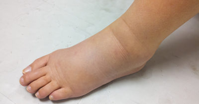 6 Common Water Retention Causes And How To Avoid It