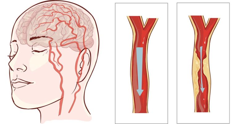 5 Warning Signs Of Poor Circulation In The Legs, Fingers And Blood