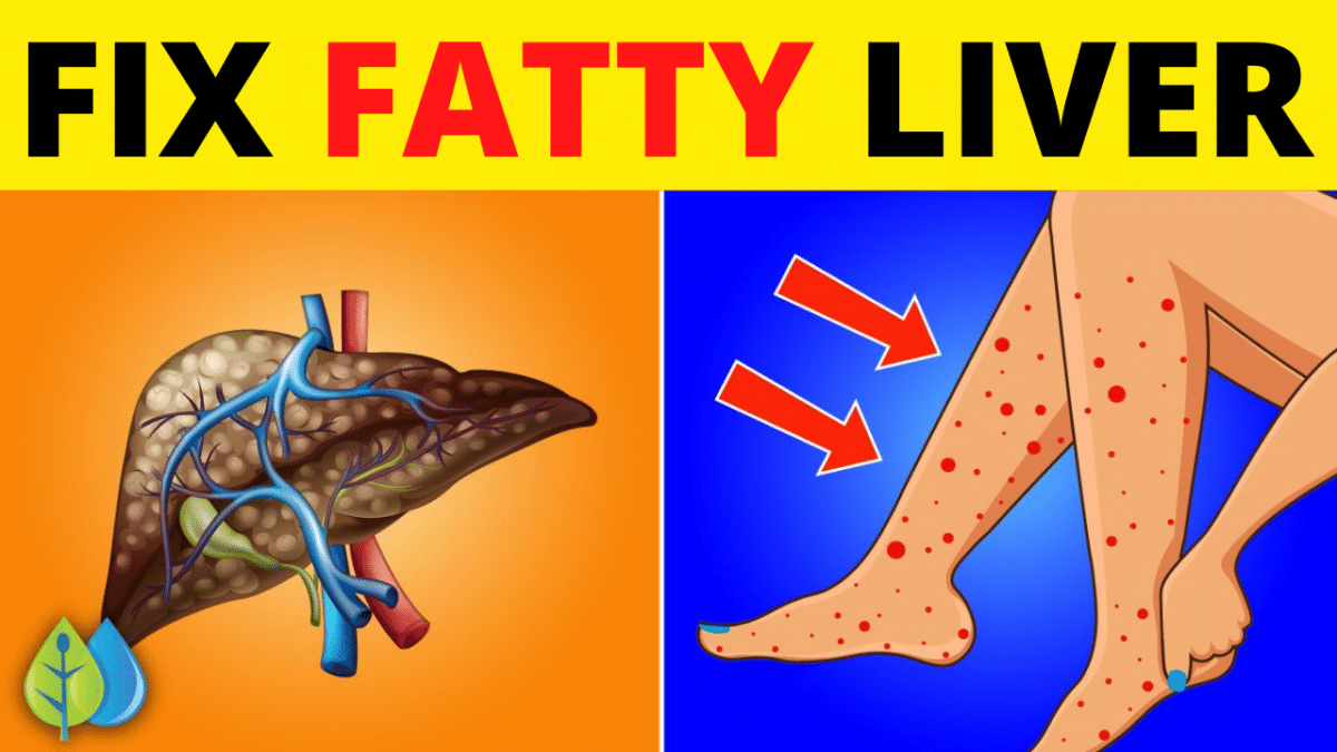 7 Signs And Symptoms Of Fatty Liver You Need To Know