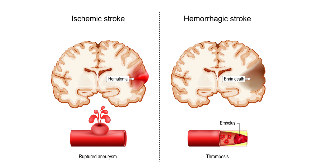 Spot these 10 warning signs of a stroke one week before
