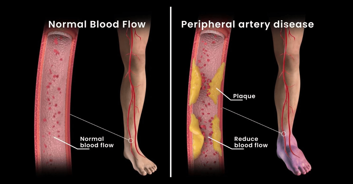 Doctors Warn: 10 Silent Signs Your Leg Arteries Are Clogged