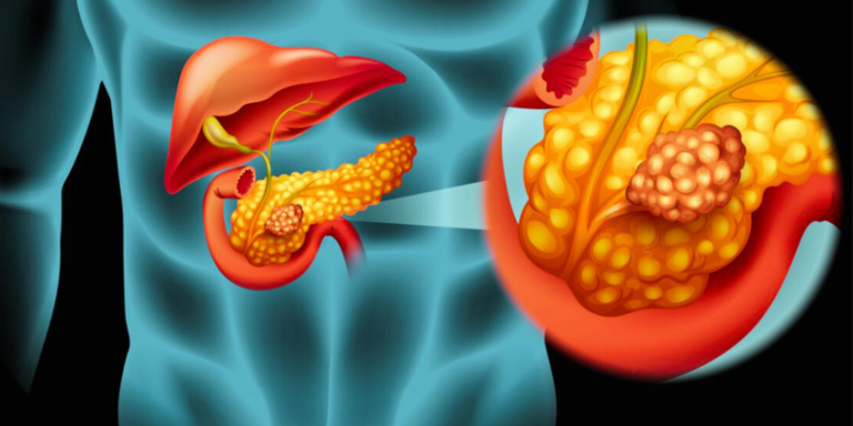 World’s Deadliest Cancer: 8 Early Warning Signs Every Older Adult ...