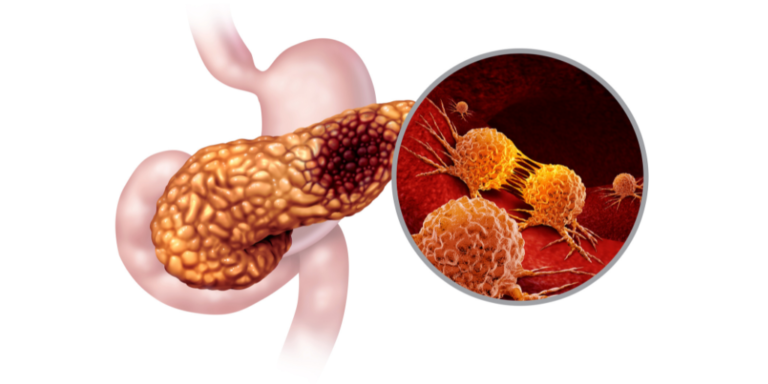 World’s Deadliest Cancer: 8 Early Warning Signs Every Older Adult ...