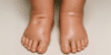 7 Warning Signs Of Kidney Failure In Your Feet – #5 Is Easy To Miss!