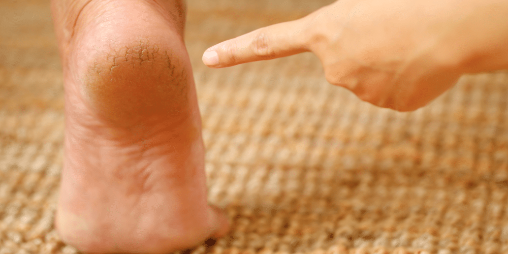 7 Nutrient Deficiencies Your Feet Can Expose
