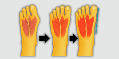 How To Get Rid Of Bunions For Good: The 5-step Solution You Need To Try