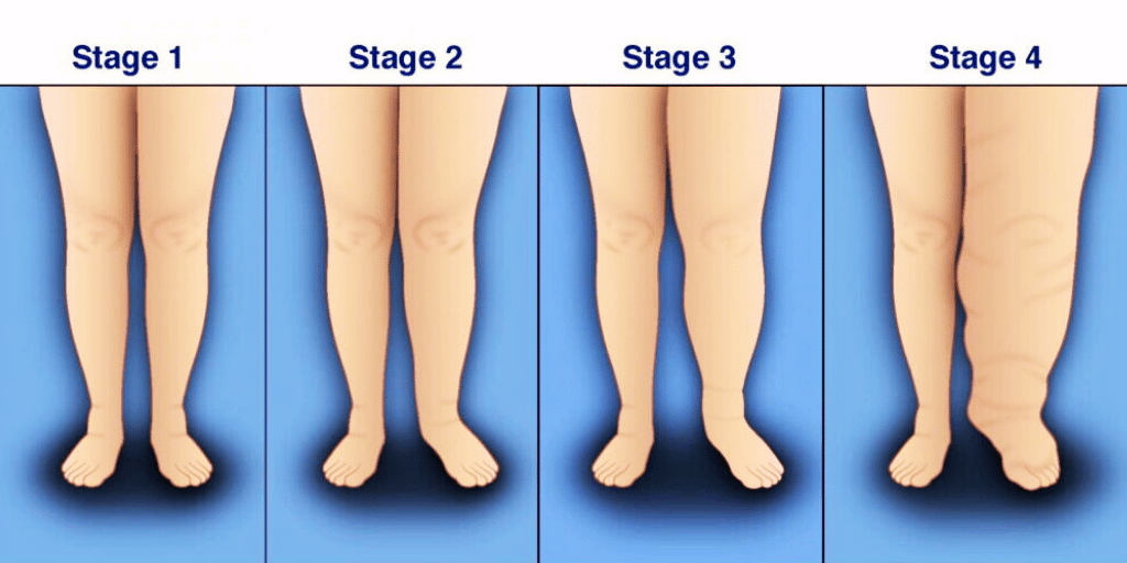 Got Swollen Feet Or Ankles? Here’s How To Fix It (lymphedema Treatment)