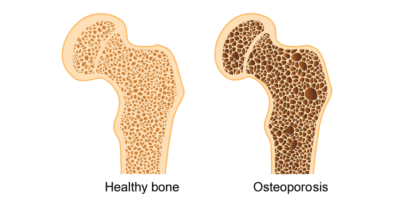 The 2 BEST Science-backed Exercises To Strengthen Your Bones After 50